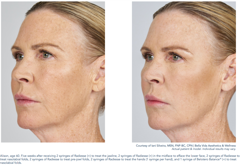 Radiesse® Collagen Boosters - YYC BOTOX